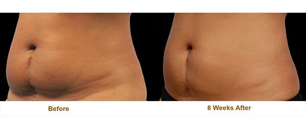 Coolsculpting Fat Removal Houston TX | Dr. Shel Wellness & Aesthetic Center