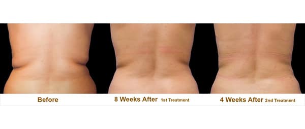 Coolsculpting Fat Removal Houston TX | Dr. Shel Wellness & Aesthetic Center