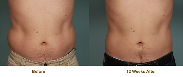 Coolsculpting Fat Removal Houston TX | Dr. Shel Wellness & Aesthetic Center