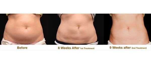 Coolsculpting Fat Removal Houston TX | Dr. Shel Wellness & Aesthetic Center