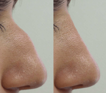 Revealing a More Beautiful You With the Power of Dermal Fillers - Dr. Shel Wellness & Aesthetic ...