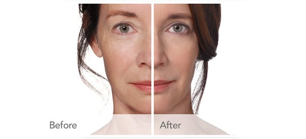 Radiesse Sugar Land TX | Dr. Shel Wellness Spa