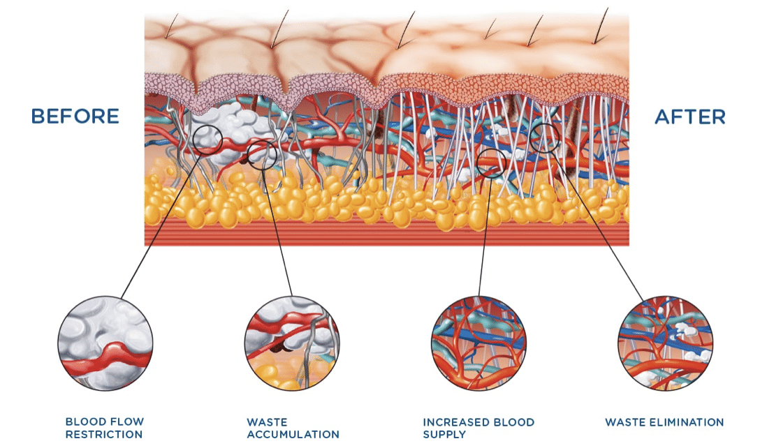 Cellutone - Dr. Shel Wellness & Aesthetic Center