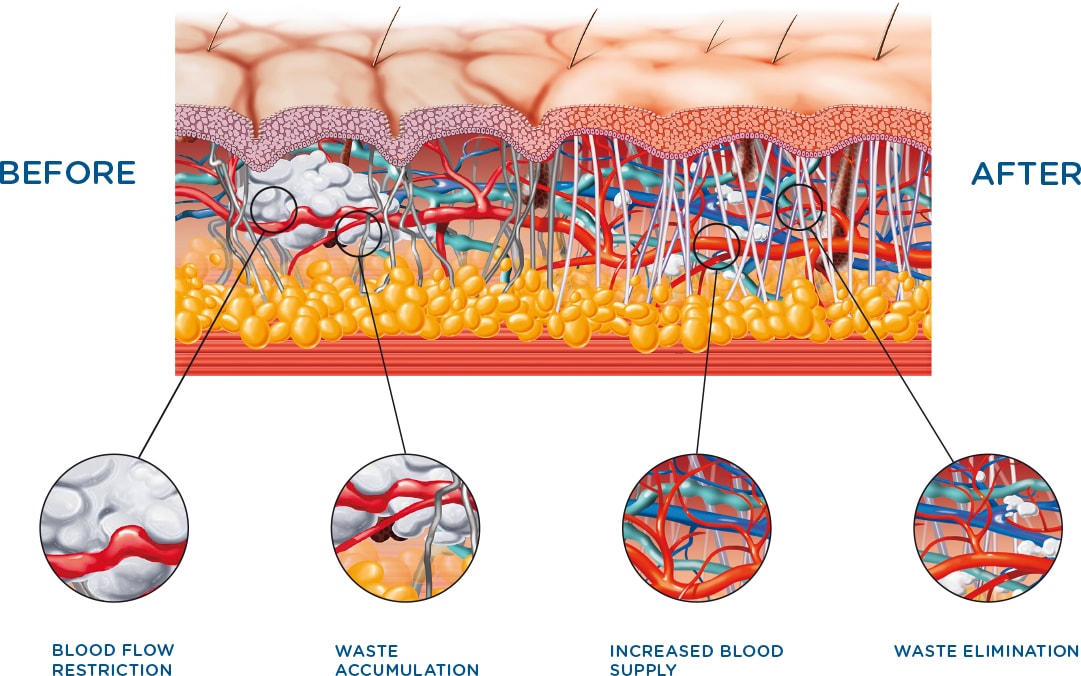 Cellutone Cellulite Reduction Sugar Land - Dr. Shel Wellness ...